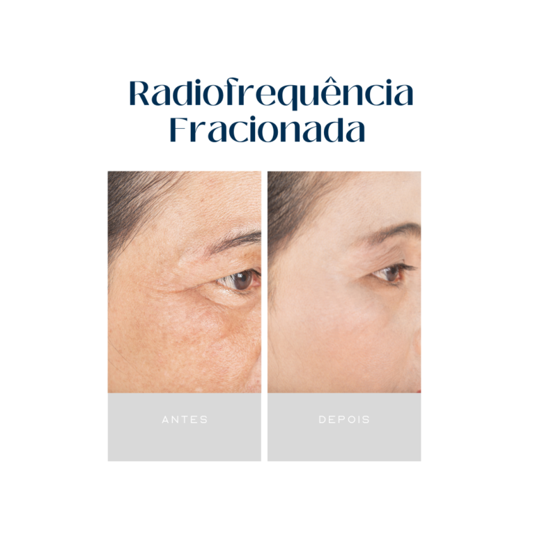 BodyTite - A alternativa minimamente invasiva e inovadora para ...